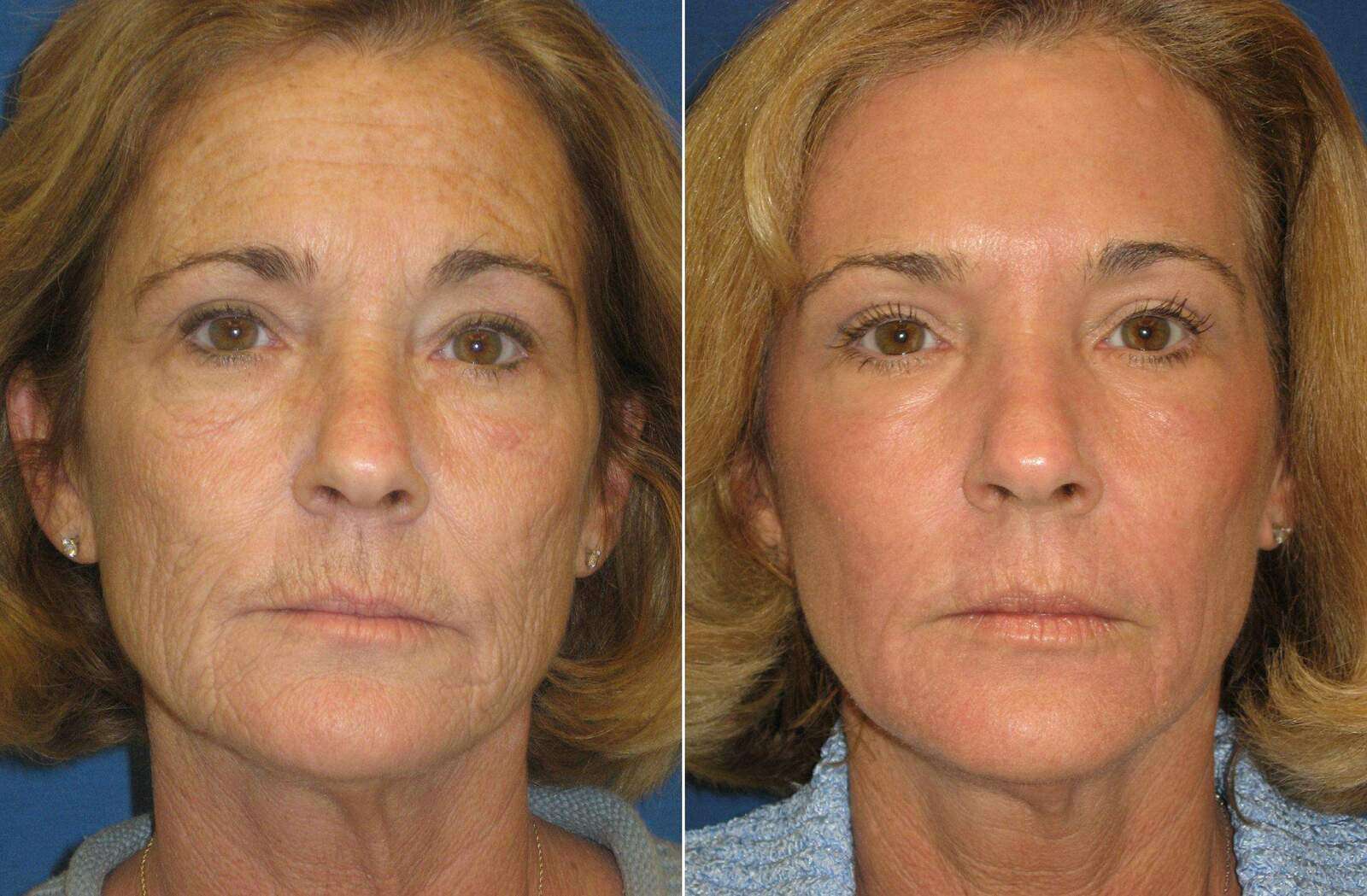 Reisender Bestimmt S chtiger Laser Resurfacing Before And After Eingang