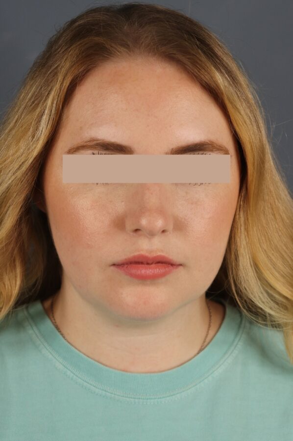 Neck Contouring (Neck Liposuction) | Waldman Schantz Turner Plastic ...