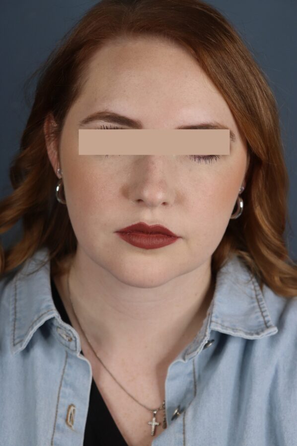 Neck Contouring (Neck Liposuction) | Waldman Schantz Turner Plastic ...